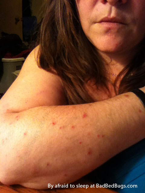 What Do Bed Bug Bites Look Like?