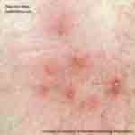 Mite Bites: Symptoms, Treatment and Prevention